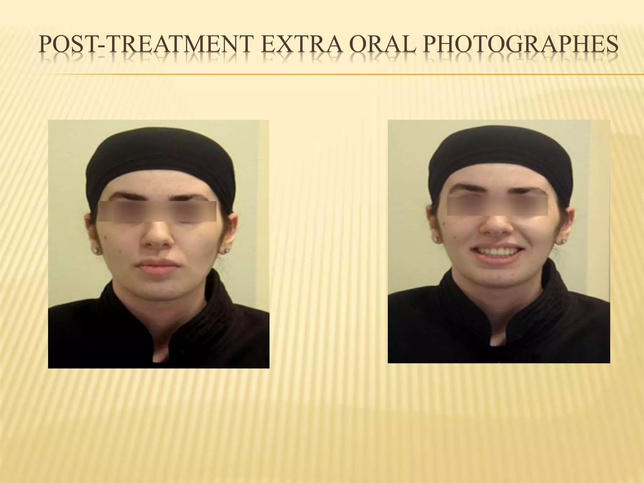 Transposition tooth corrected by orthodontic | PPTX