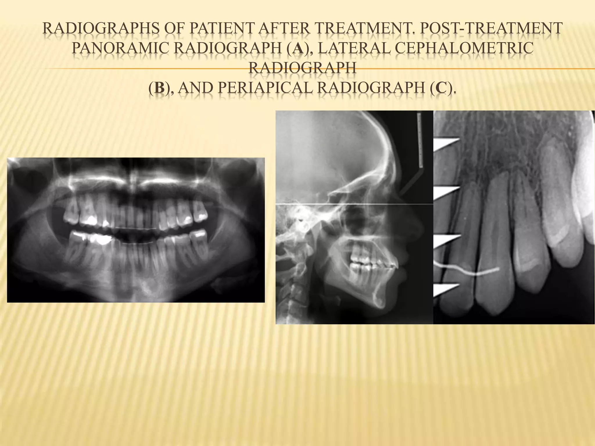 Transposition tooth corrected by orthodontic | PPTX