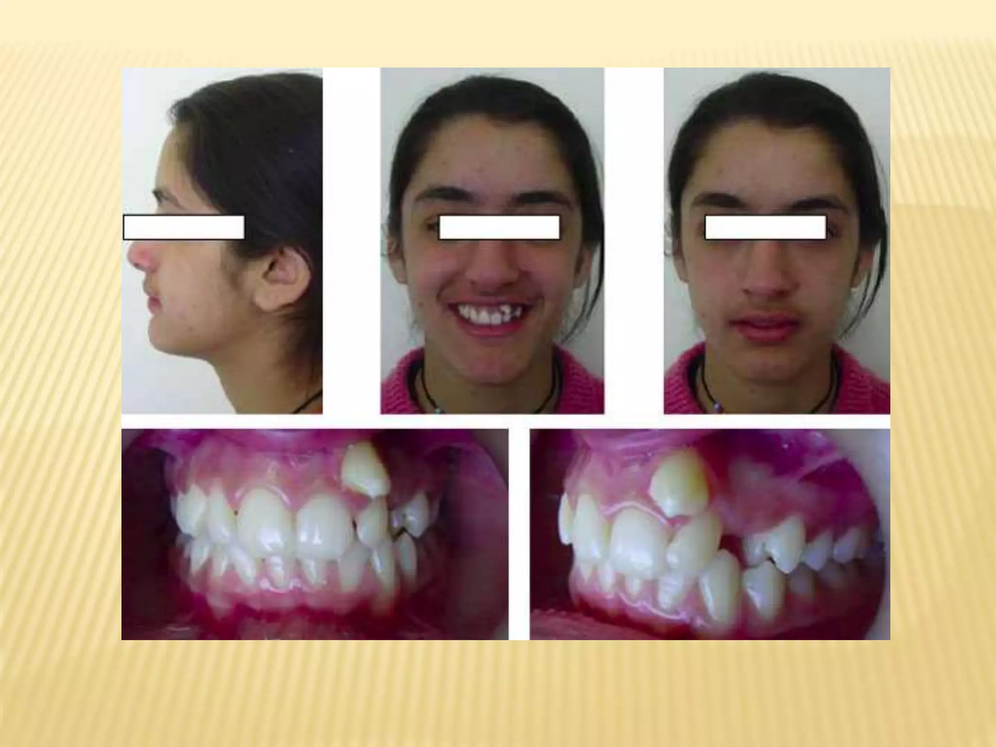 Transposition tooth corrected by orthodontic | PPTX