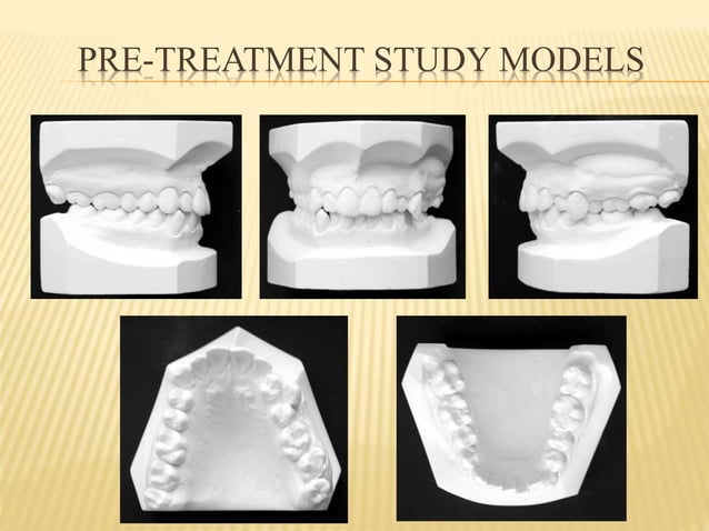 Transposition tooth corrected by orthodontic | PPTX