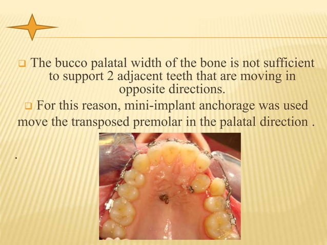 Transposition tooth corrected by orthodontic | PPTX