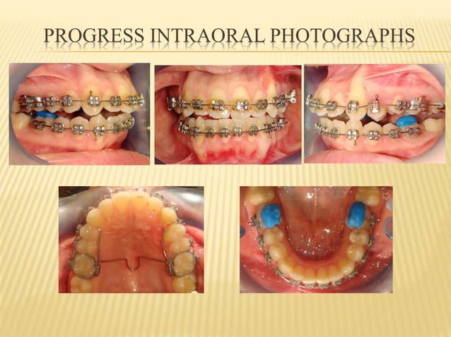 Transposition tooth corrected by orthodontic | PPTX