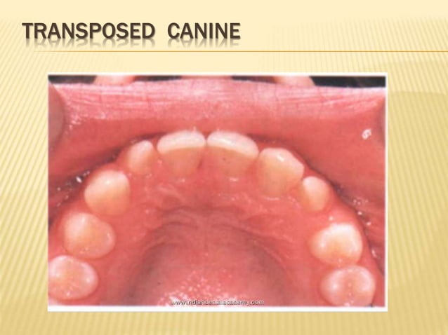 Transposition tooth corrected by orthodontic | PPTX