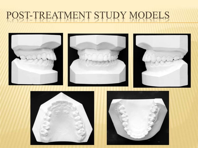 Transposition tooth corrected by orthodontic | PPTX