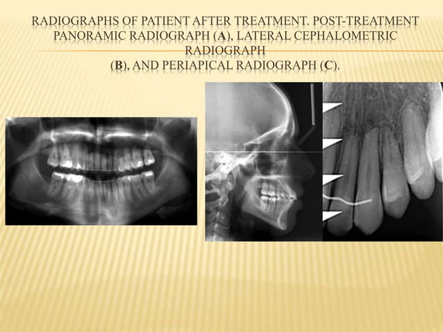 Transposition tooth corrected by orthodontic | PPTX
