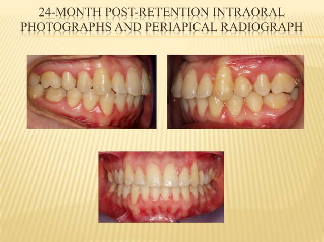 Transposition tooth corrected by orthodontic | PPTX