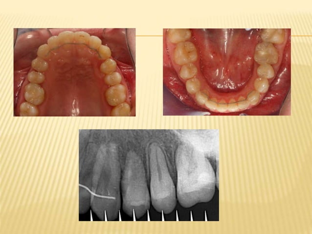 Transposition tooth corrected by orthodontic | PPTX