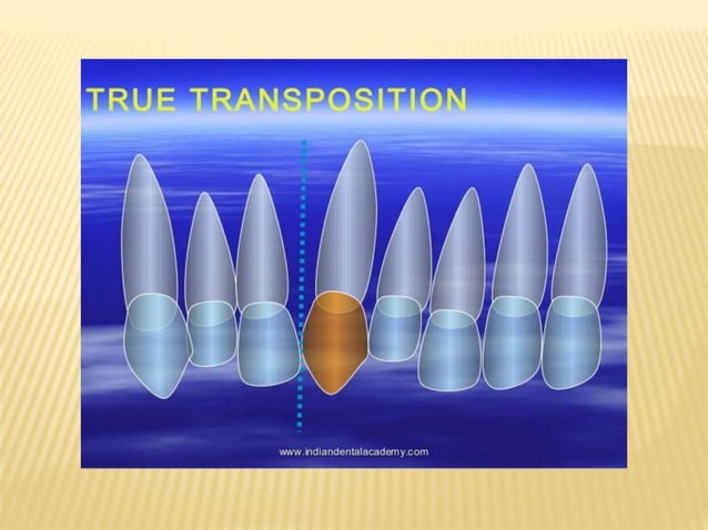 Transposition tooth corrected by orthodontic | PPTX