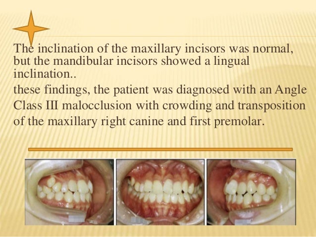Transposition tooth corrected by orthodontic