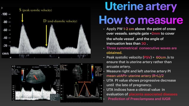 Presentation 3 uterine artery doppler .pdf | Pregnancy | Reproductive ...