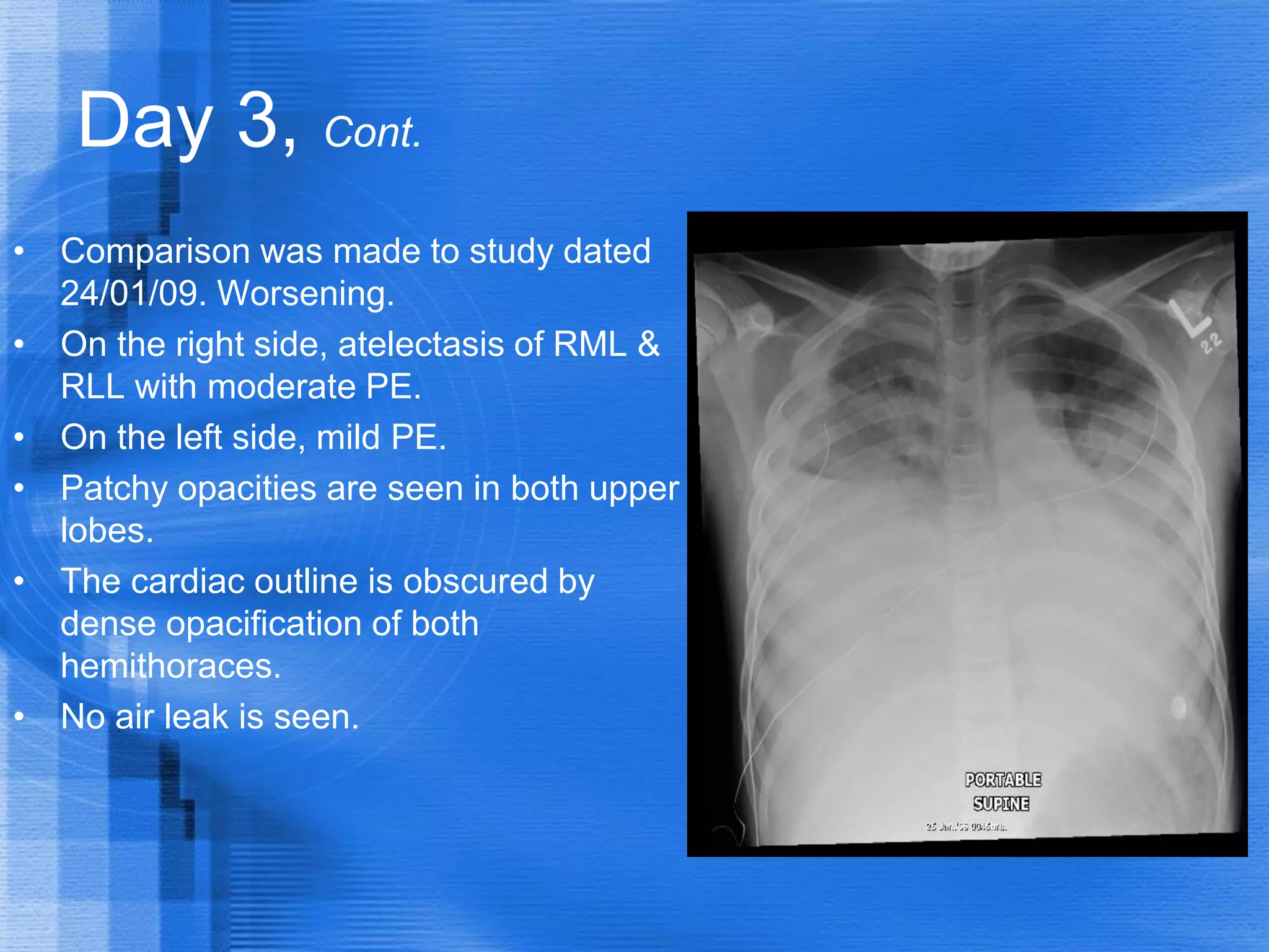 Acute Chest Syndrome of Sickle Cell Anemia | PPT