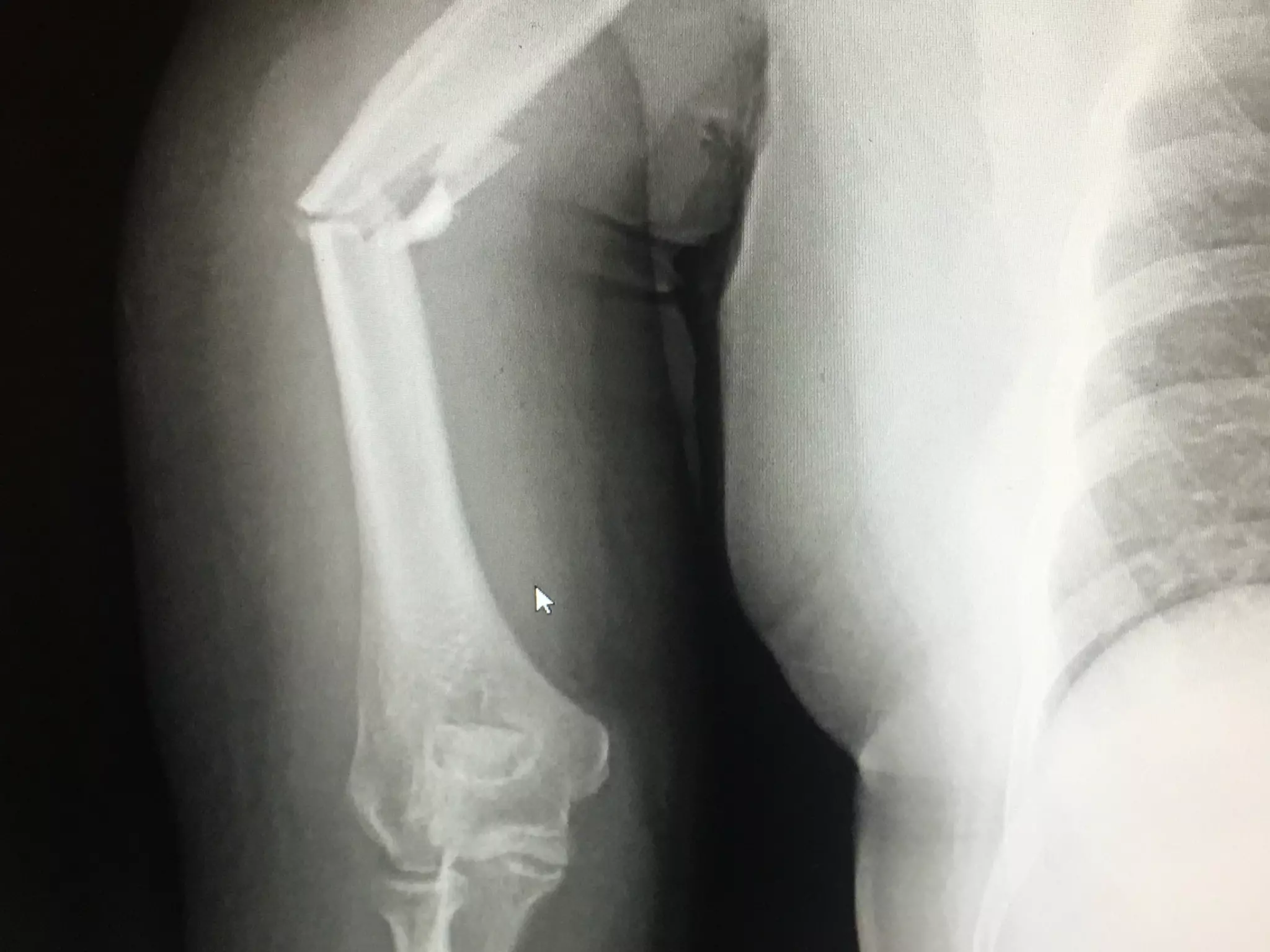 Closed fracture at the humeral shaft | PDF