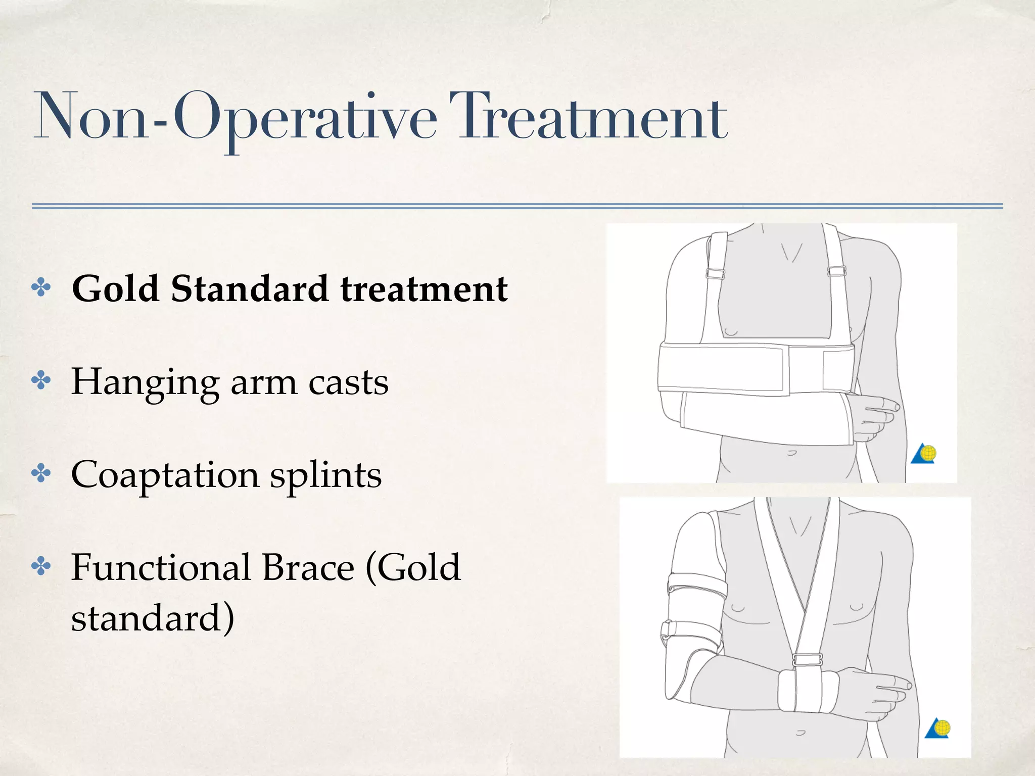 Closed fracture at the humeral shaft | PDF