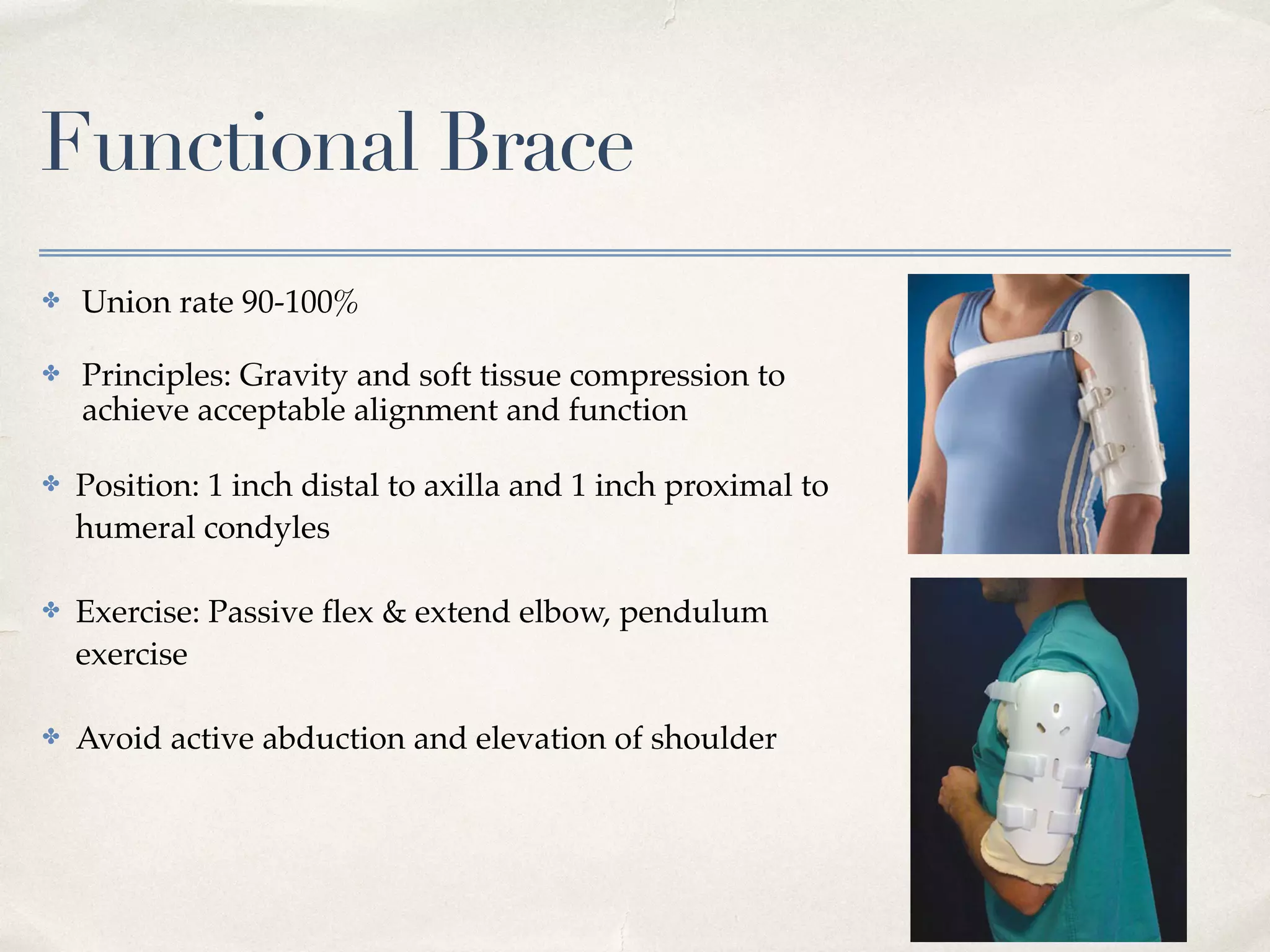 Closed fracture at the humeral shaft | PDF