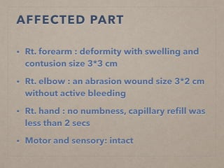Closed fracture at the humeral shaft | PDF
