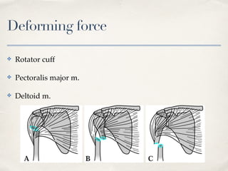 Closed fracture at the humeral shaft | PDF