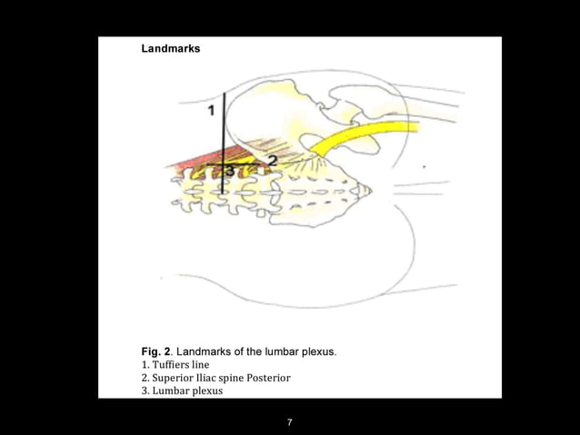 lumbar plexus block | PPTX