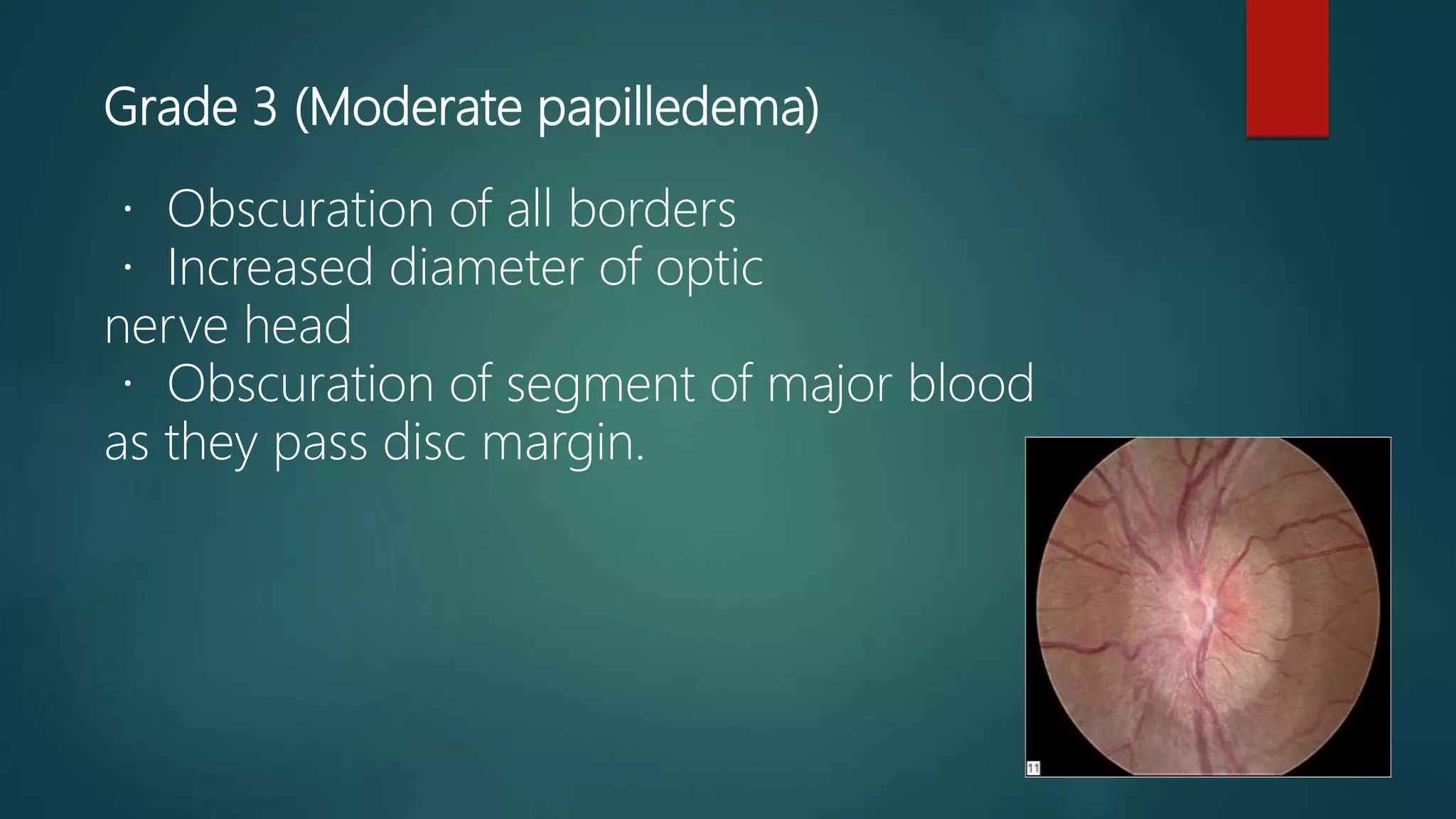 Papilledema | PPTX