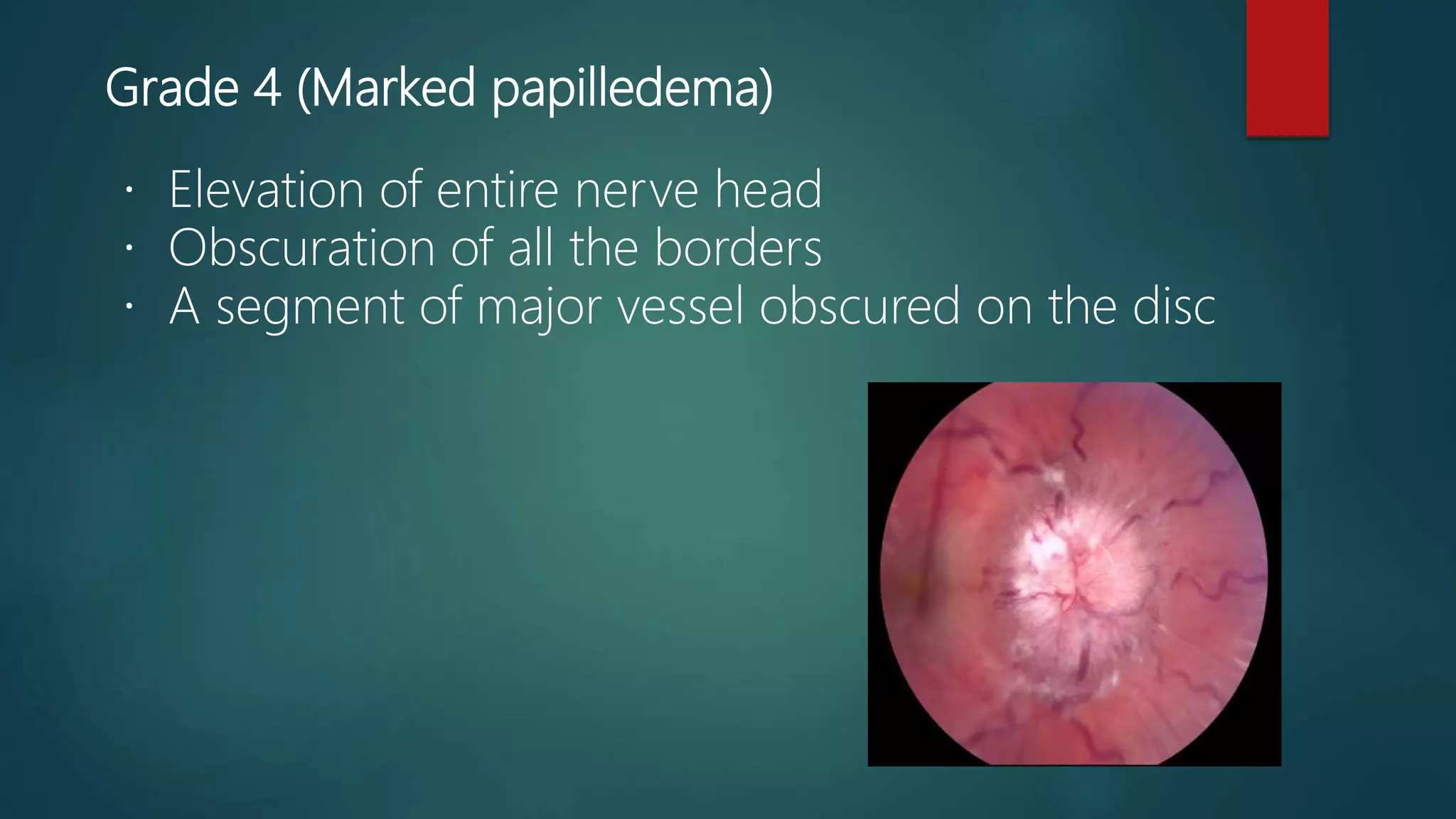 Papilledema | PPTX