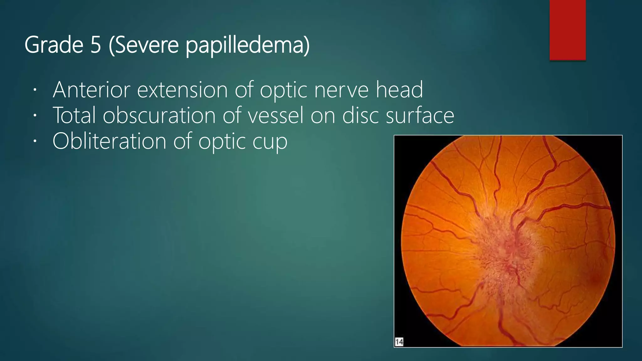 Papilledema | PPTX