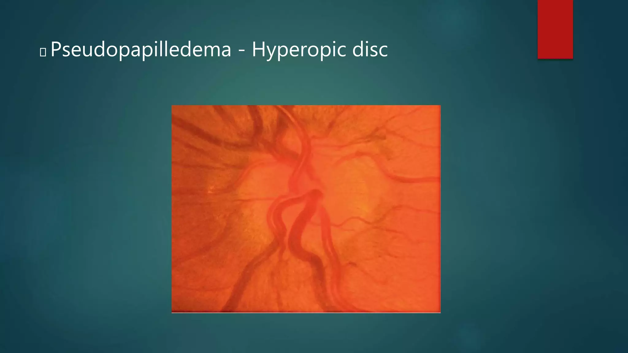 Papilledema | PPTX