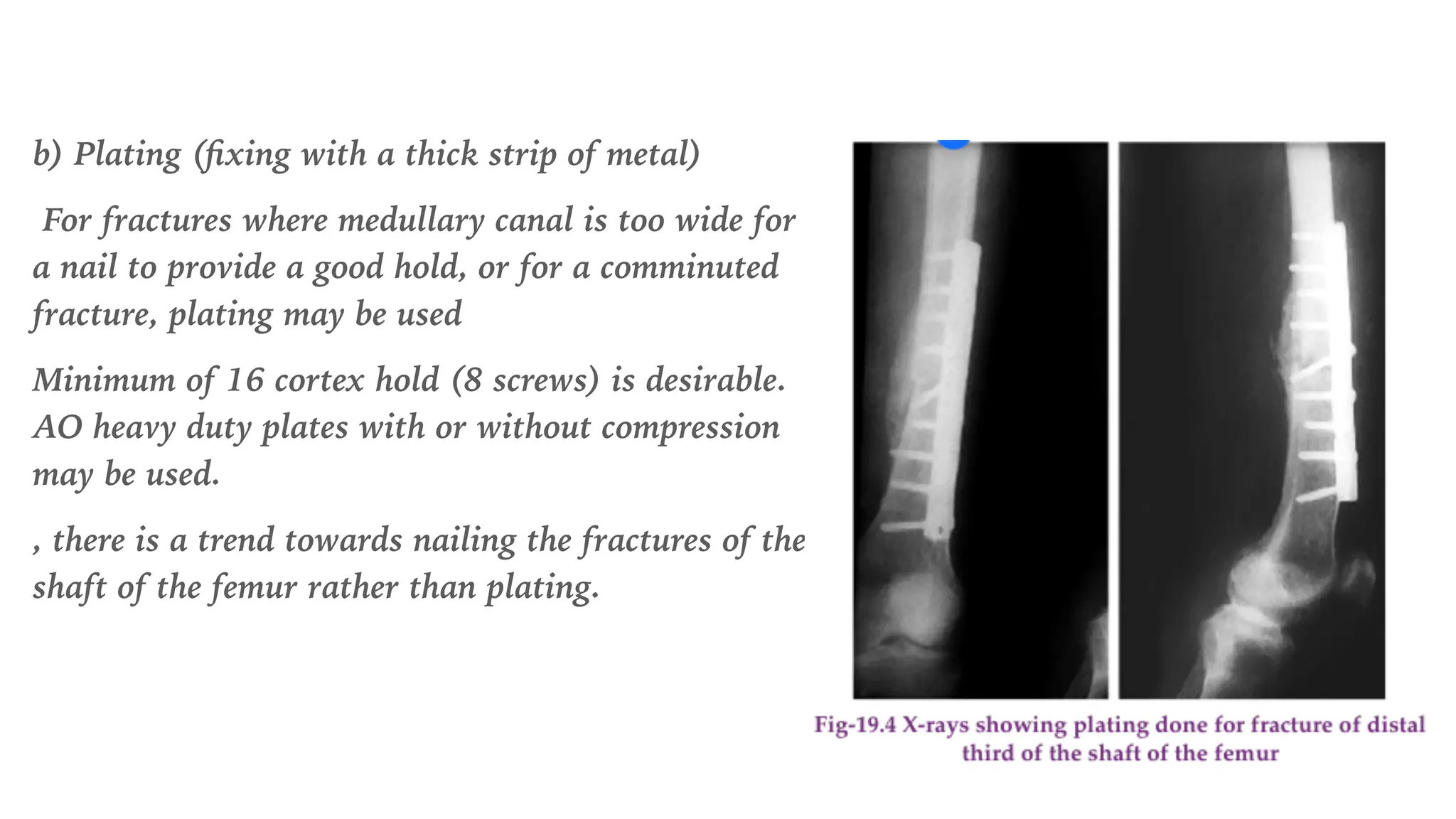 Presentation femur shaft fractures .pdf