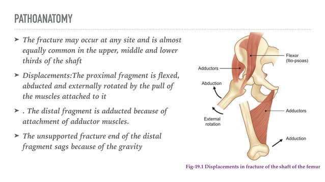 Presentation femur shaft fractures .pdf