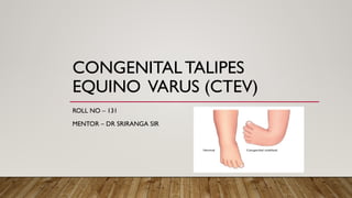 Congenital talipes equino varus Presentation (4).pptx
