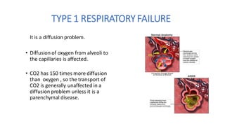 Respiratory failure by Ashish. Types and management | PDF