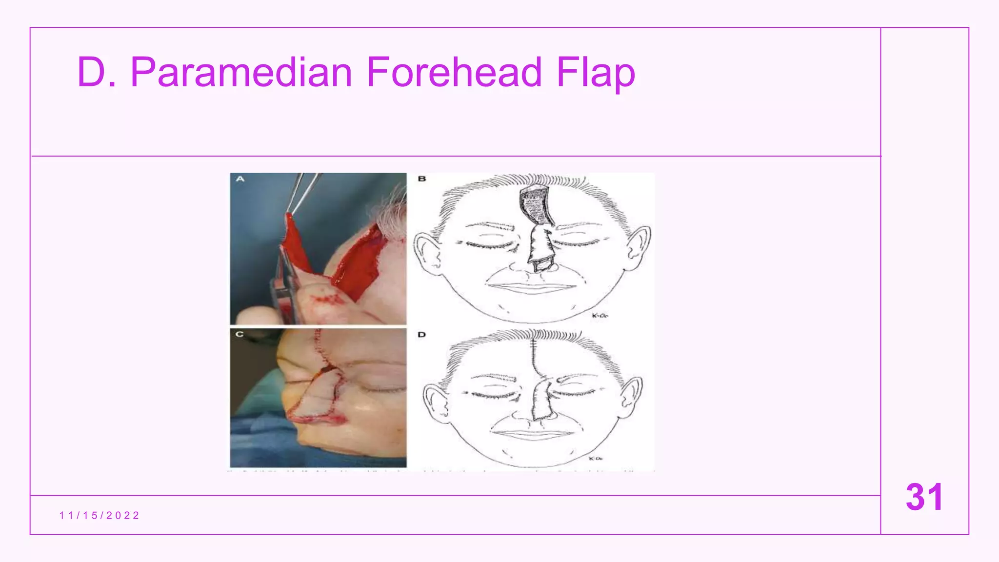 Nasal Reconstruction | PPTX