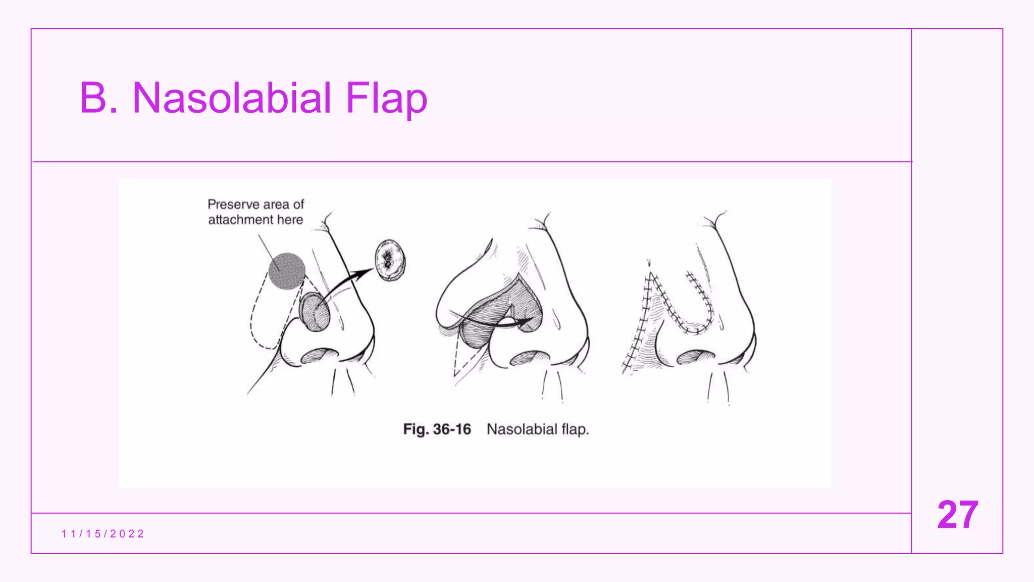 Nasal Reconstruction