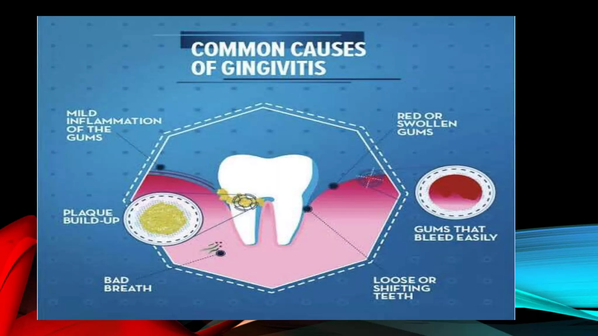 Indices Of Gingival Diseases Pptx