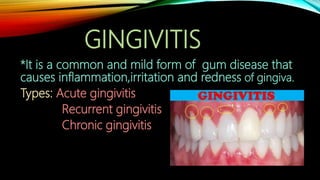 indices of gingival diseases | PPTX