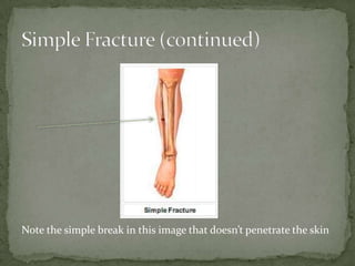 Presentation4 musculoskeletal fractures | PPT