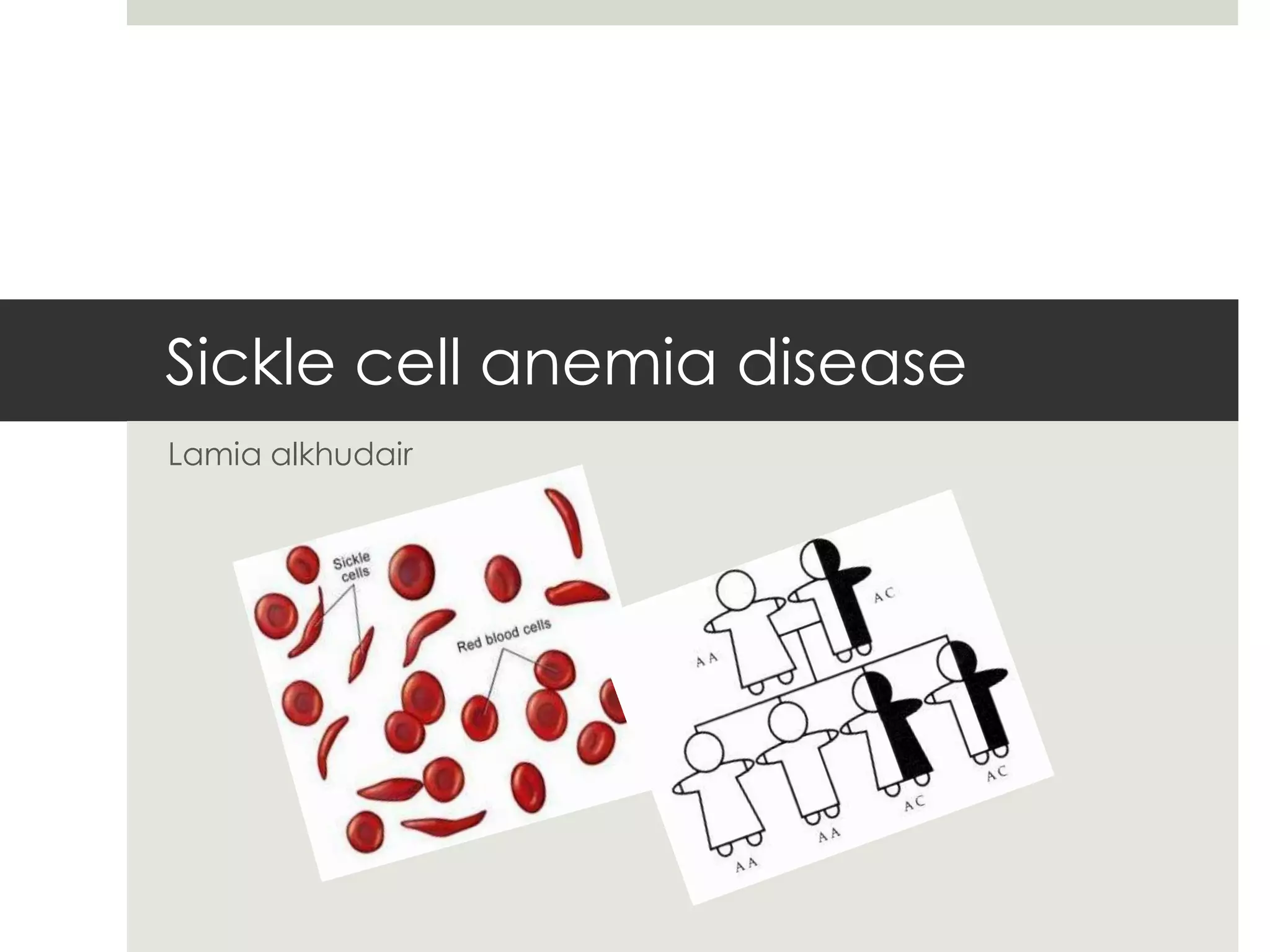 sickle cell anemia | PPTX