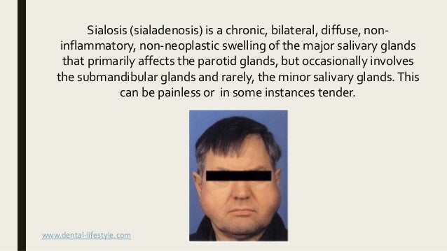 Sialoadenosis (sialosis) -maxillofacial pathology