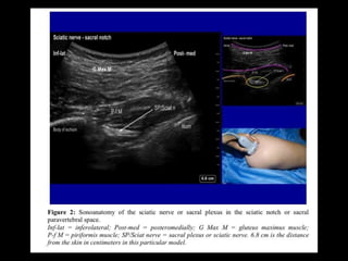 sacral plexus block | PPTX