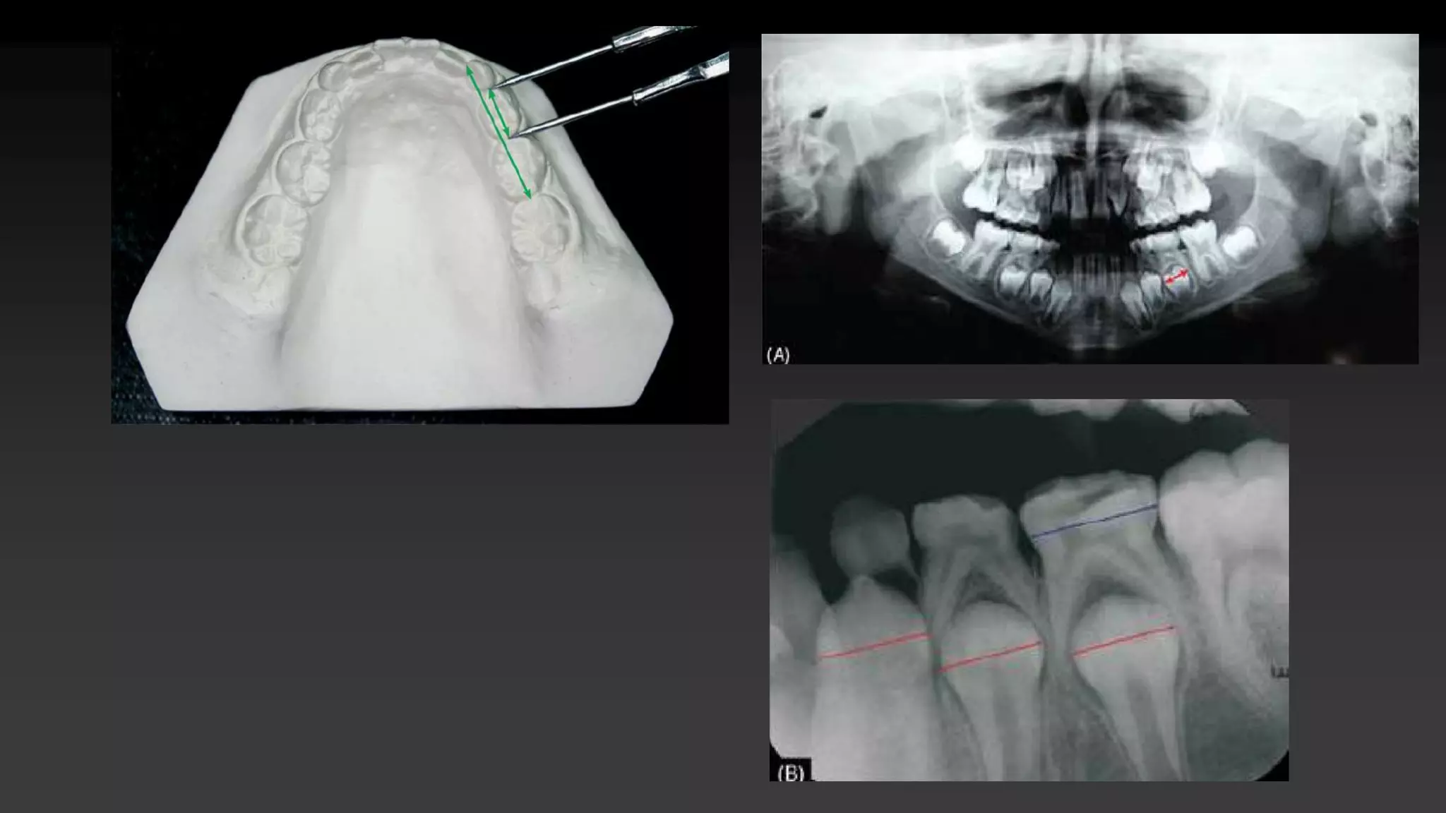 MODEL ANALYSIS : MIXED DENTITION | PPTX