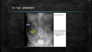 Acute adynamic neuromuscular state of small intestine with dilatation i ...