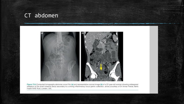 Acute adynamic neuromuscular state of small intestine with dilatation i ...