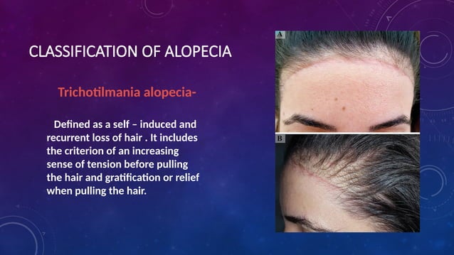 Presentation on alopecia nursing (5).pptx