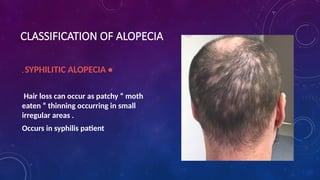 Presentation on alopecia nursing (5).pptx