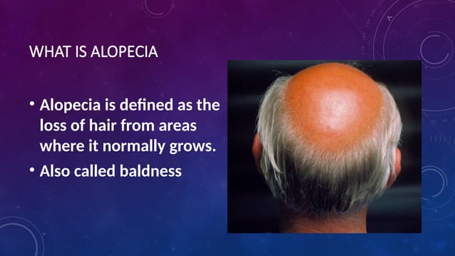 Presentation on alopecia nursing (5).pptx