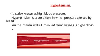 Hypertension and stages of hypertension | PPTX