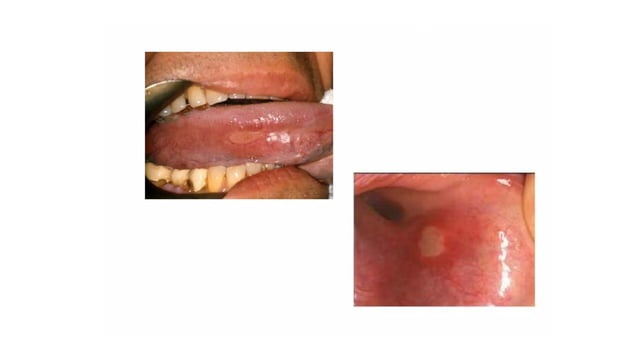 Yellow Lesions of Oral Cavity By Dr. Pushpendra | PDF
