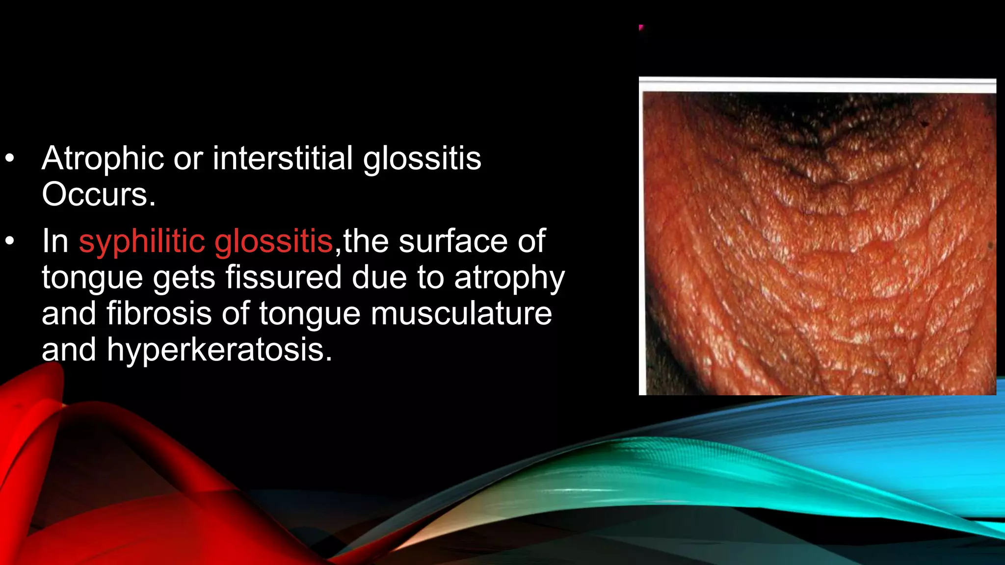 Oral manifestation of syphilis | PPTX