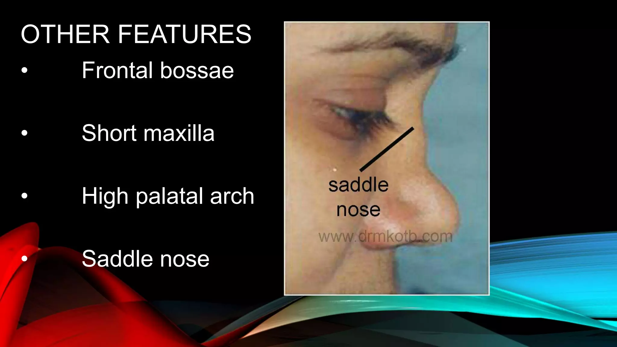 Oral manifestation of syphilis | PPTX