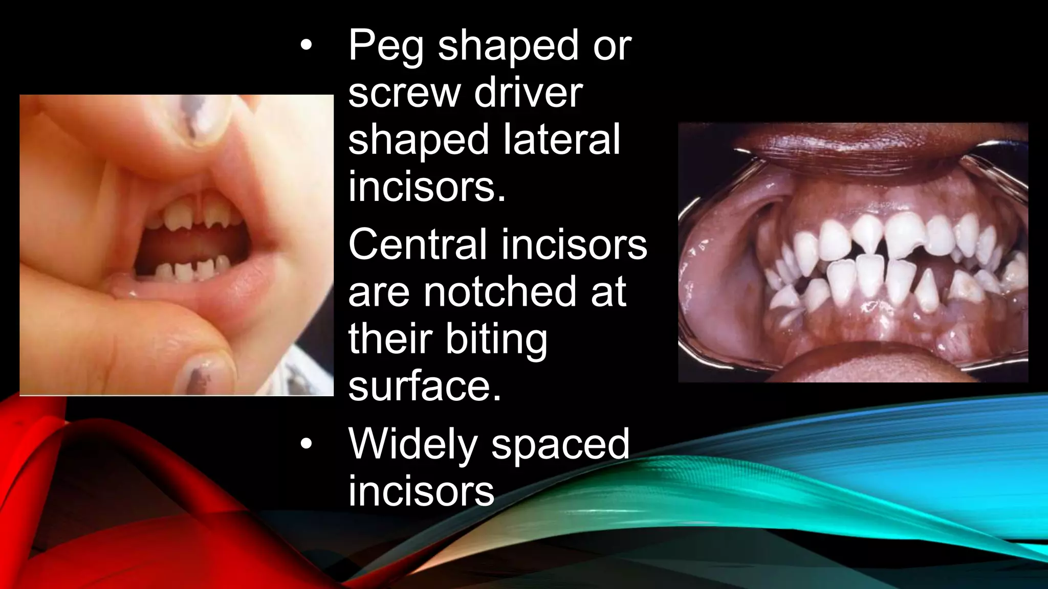 Oral manifestation of syphilis | PPTX