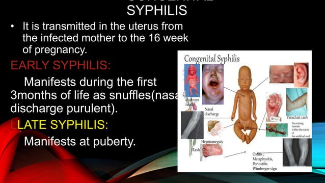 Oral manifestation of syphilis | PPT
