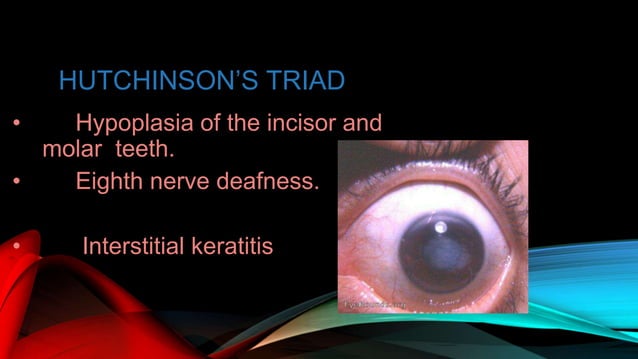 Oral manifestation of syphilis | PPTX